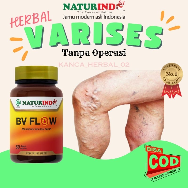 Jual Obat Varises Di Kaki Dan Betis Paling Ampuh Obat Varises Urat ...