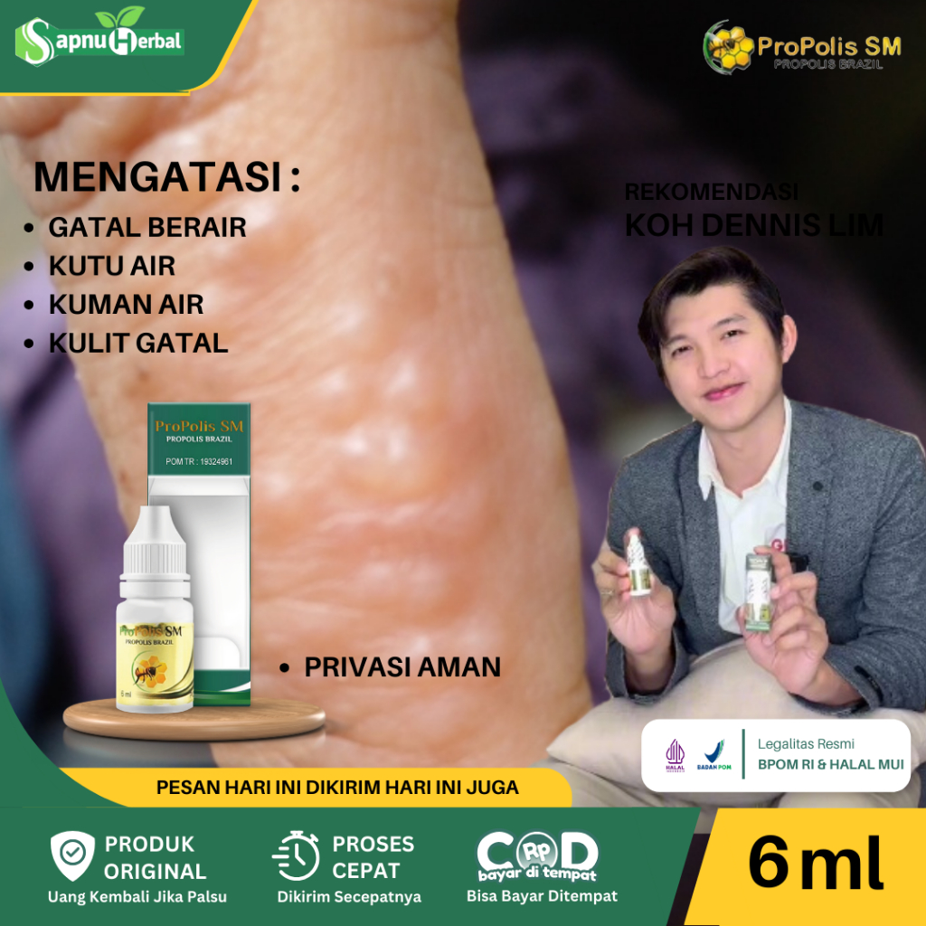 Jual Obat Kutu Air, Penghilang Kuman Air, Gatal Berair, Kutu Air Pada ...