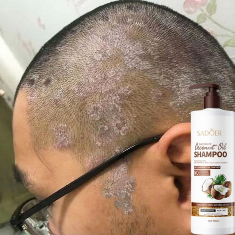 Jual 500ML Shampo Kelapa Shampoo Anti Ketombe Sampo Ketombe Sampo Anti Ketombe Obat Ketombe ...