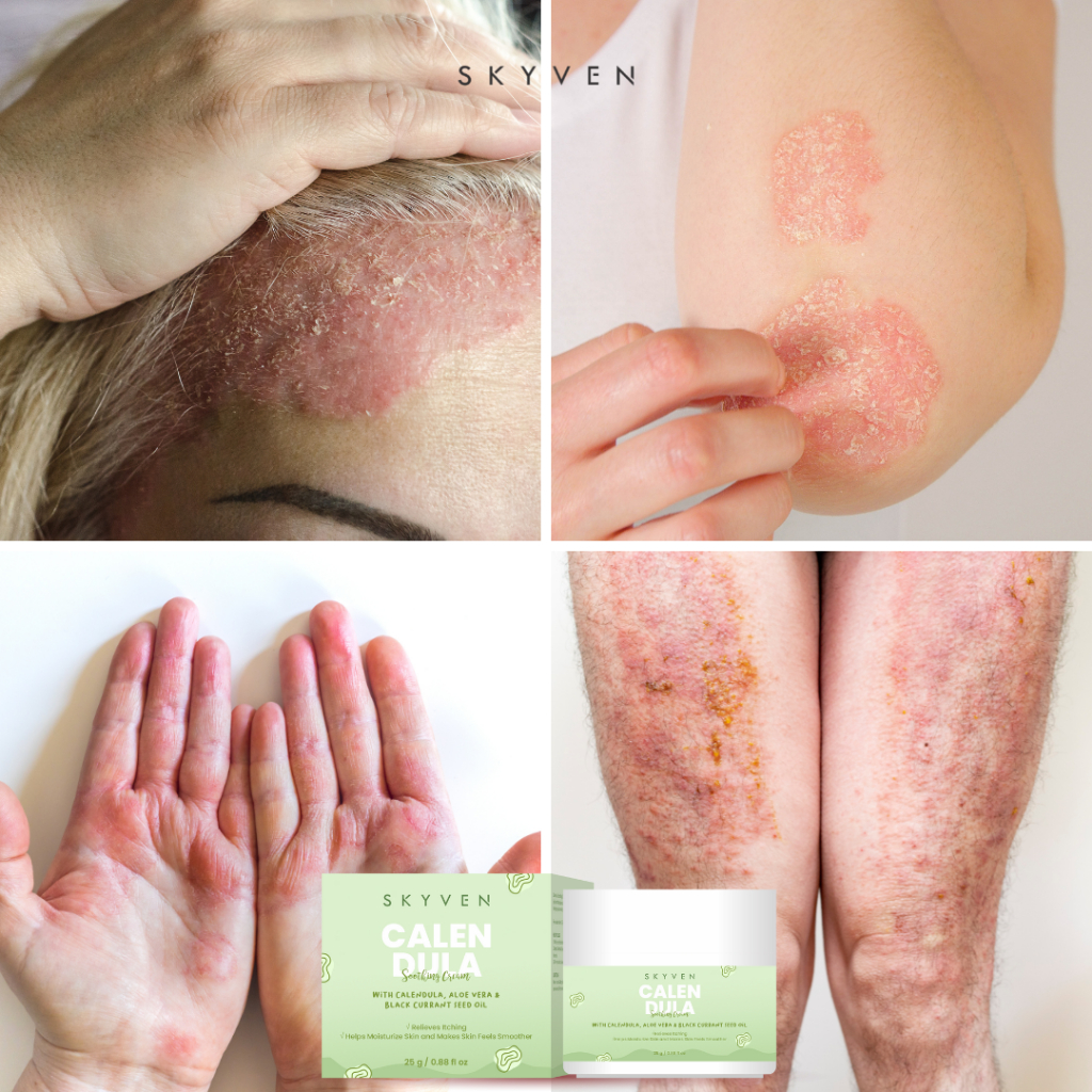 Jual Cream Mengobati Jerawat/Eksim Gatal dan Ruam - SKYVEN Calendula ...