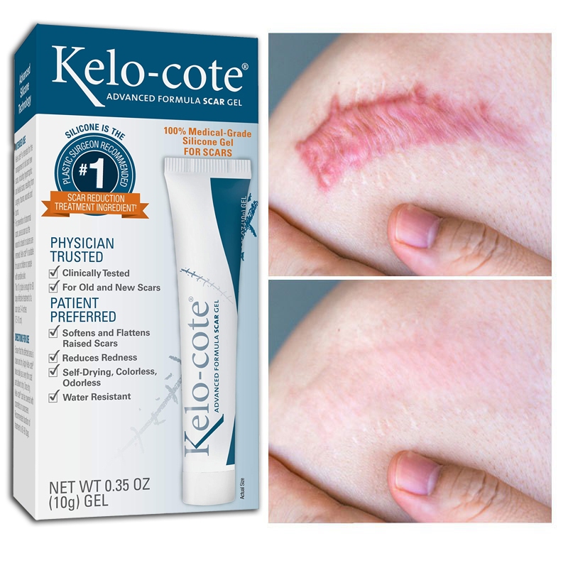 Jual Kelo Cote Advanced Formula Scar Gel 10gr / Scar Removal Ointment ...