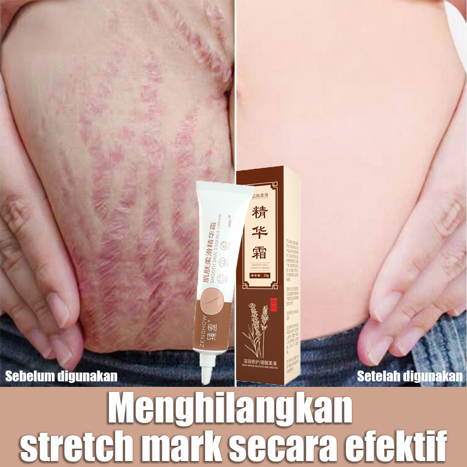 Jual Stretch Mark Cream Streachmark Paling Ampuh Cream Penghilang ...