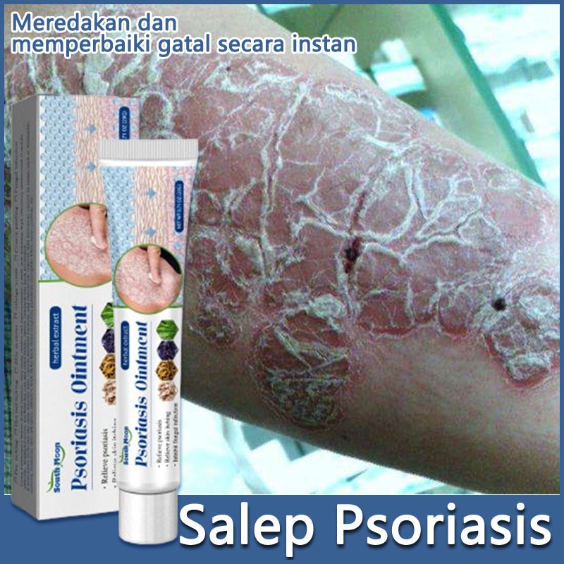Jual Salep gatal obat kurap 20g obat eksim salap gatal kulit yang ampuh ...