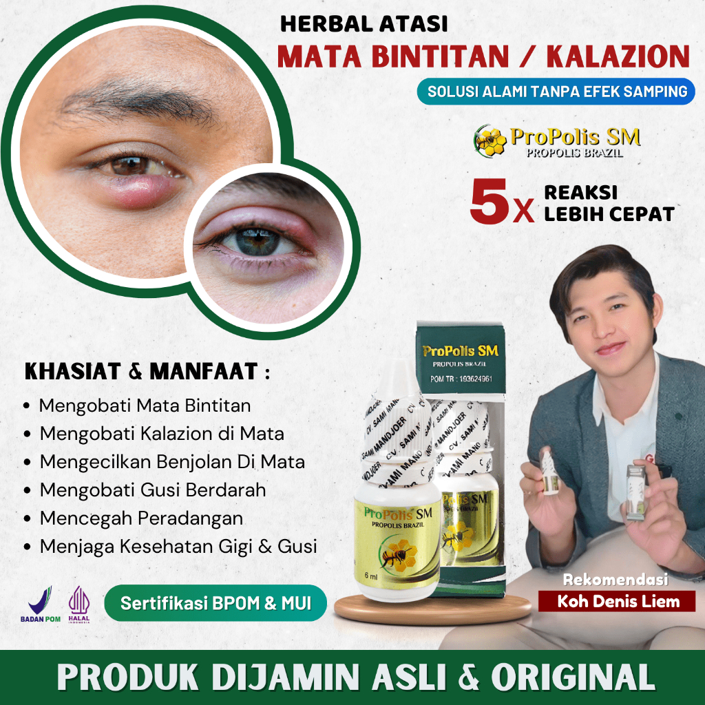 Jual PROPOLIS SM Obat Bintitan Kalazion Salep Penghilang Benjolan di ...