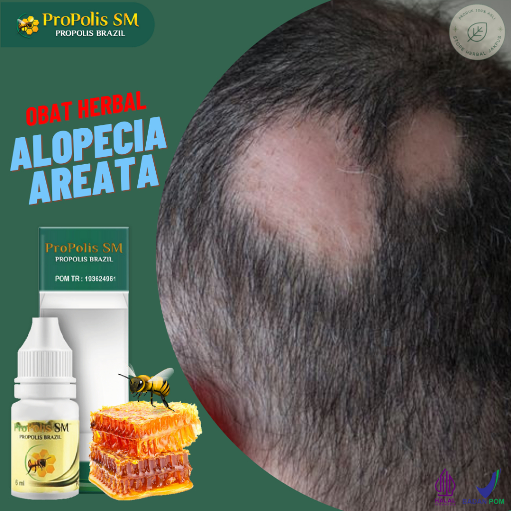 Jual Obat Alopecia Areata Rambut Pitak Obat Botak Koin Obat Tinea ...