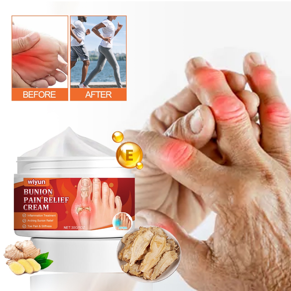 Jual 30g Obat Asam Urat Paling Ampuh Gout Cream Gout Treatment Joint ...