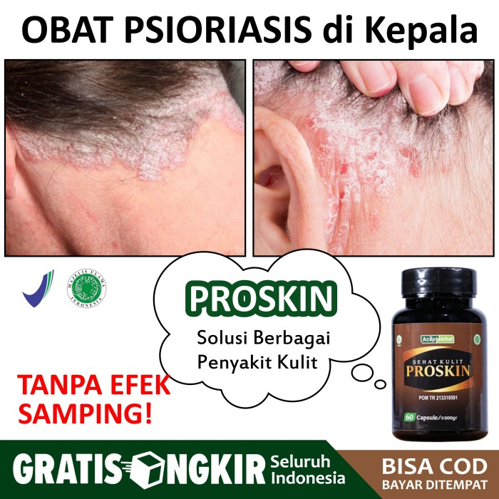 Jual Obat Psoriasis Kepala Alami Untuk Penghilang Ketombe Berkerak dan Gatal PROSKIN 60 kapsul ...