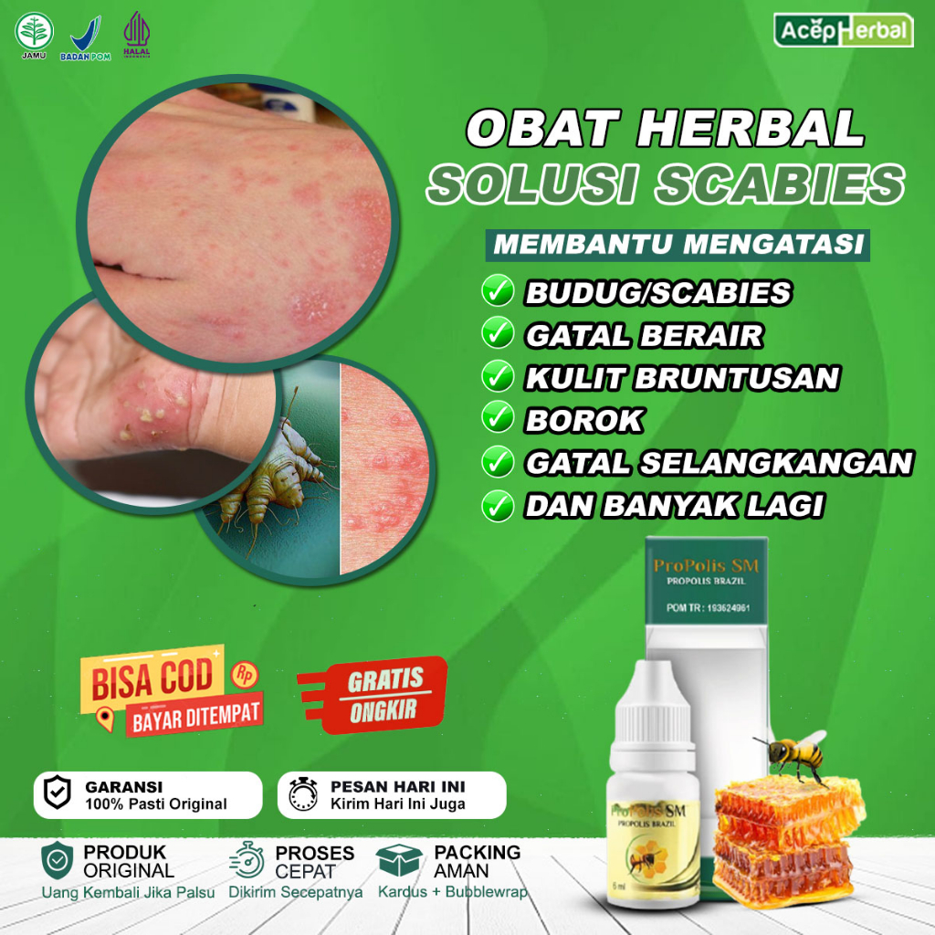 Jual Obat Budug Scabies Kudis Eksim Gatal Ruam Kulit Bintik Bintik Luka ...