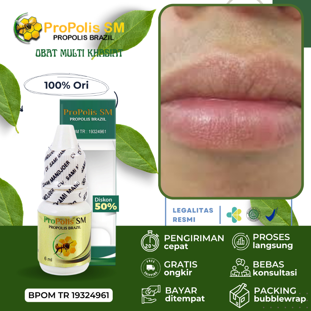Jual Obat Oles Penghilang Bintik Putih di Bibir, Obat Fordyce Spot ...