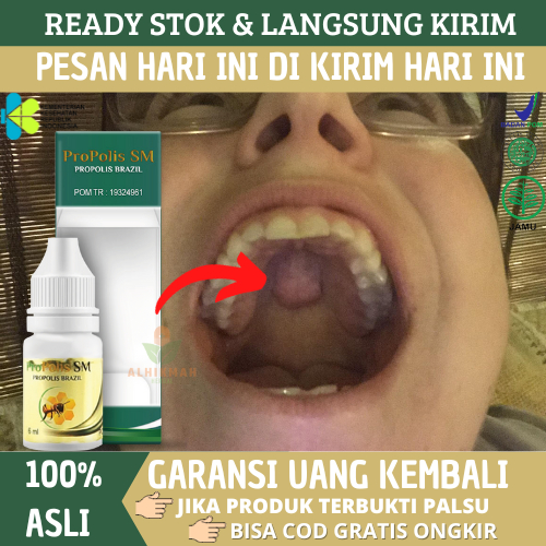 Jual Obat Benjolan di Langit Mulut / Torus Palatinus Tulang Jinak Di ...