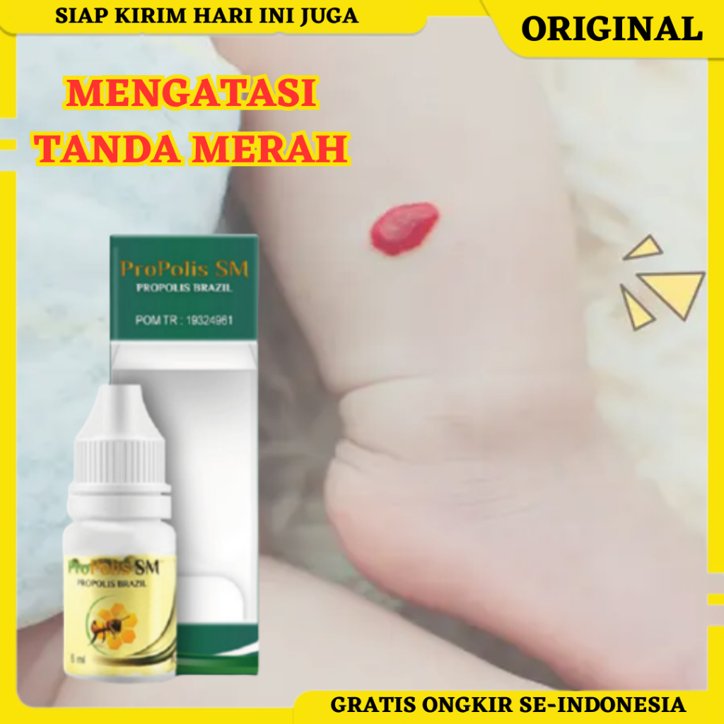 Jual Propolis SM, Obat Hemangioma, Obat Gumpalan Darah Merah Pada Bayi ...