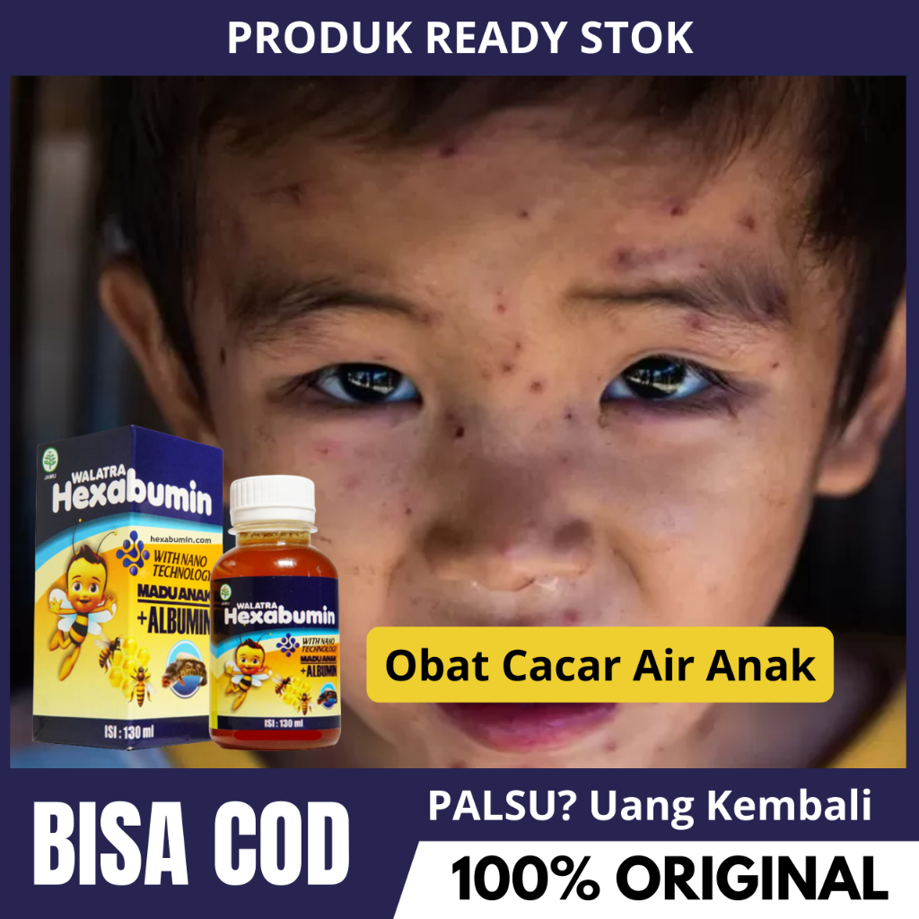 Jual Obat Cacar Air Anak, Pengobatan Cacar Air Anak, Obat Antivirus ...
