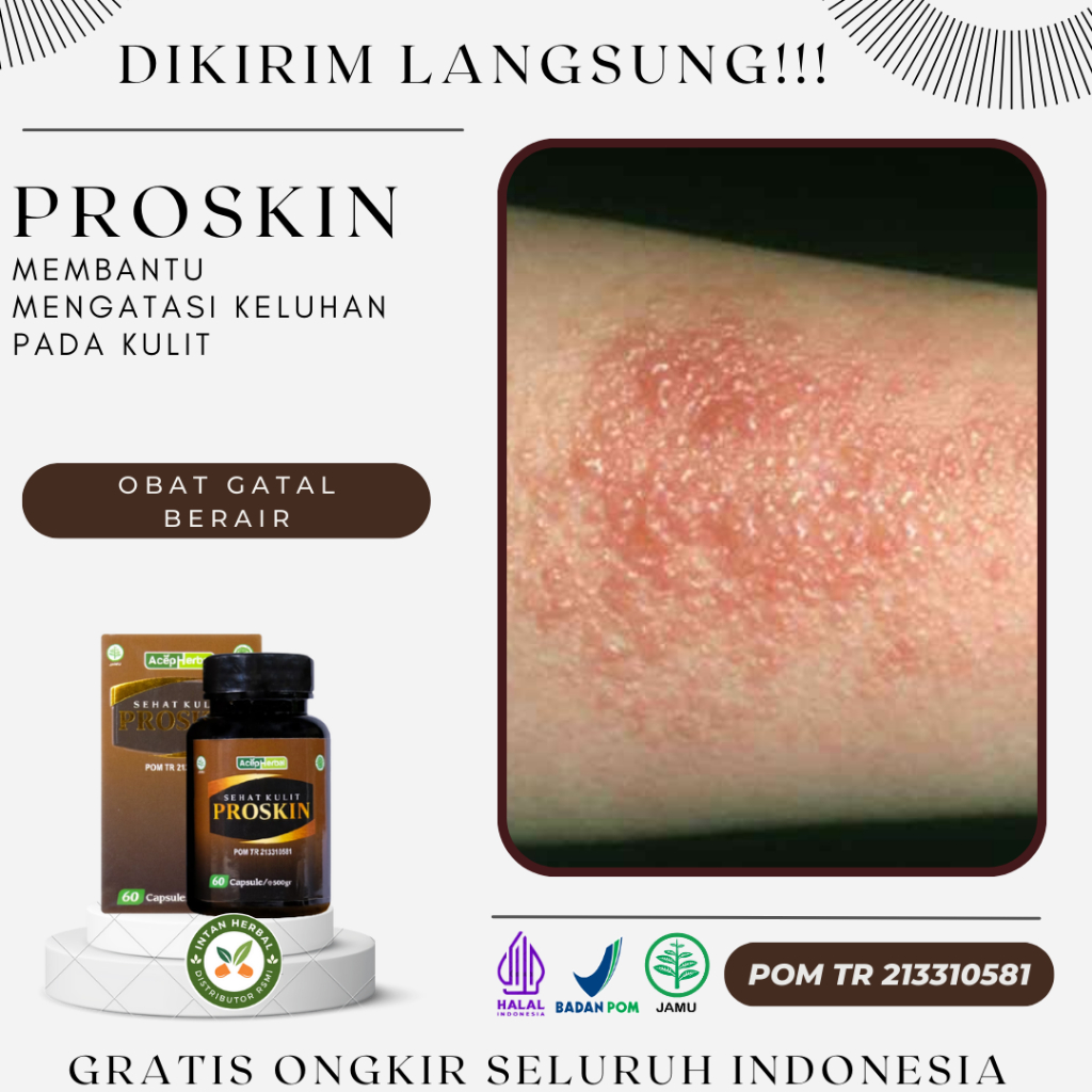 Jual Proskin - Obat Gatal Berair, Gatal Berair Di Jari Tangan Dan Kaki ...