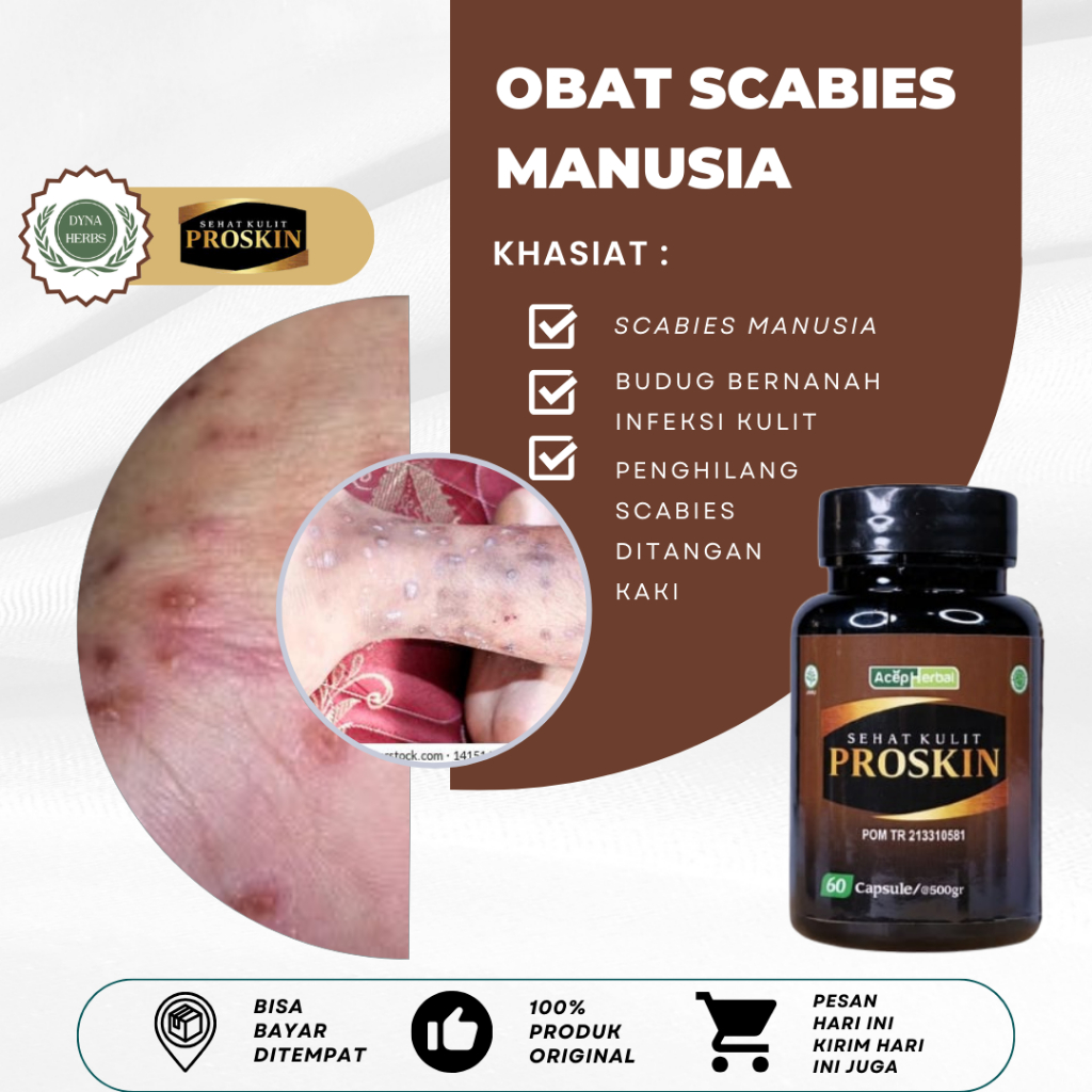Jual Obat Scabies Manusia Scabies Gatal Kulit Seluruh Badan Gudik ...