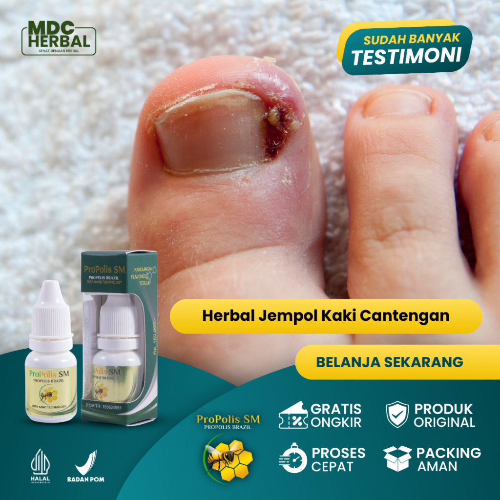 Jual Obat Jempol Kaki Cantengan Parah, Jempol Kaki Bengkak, Jempol Kaki ...