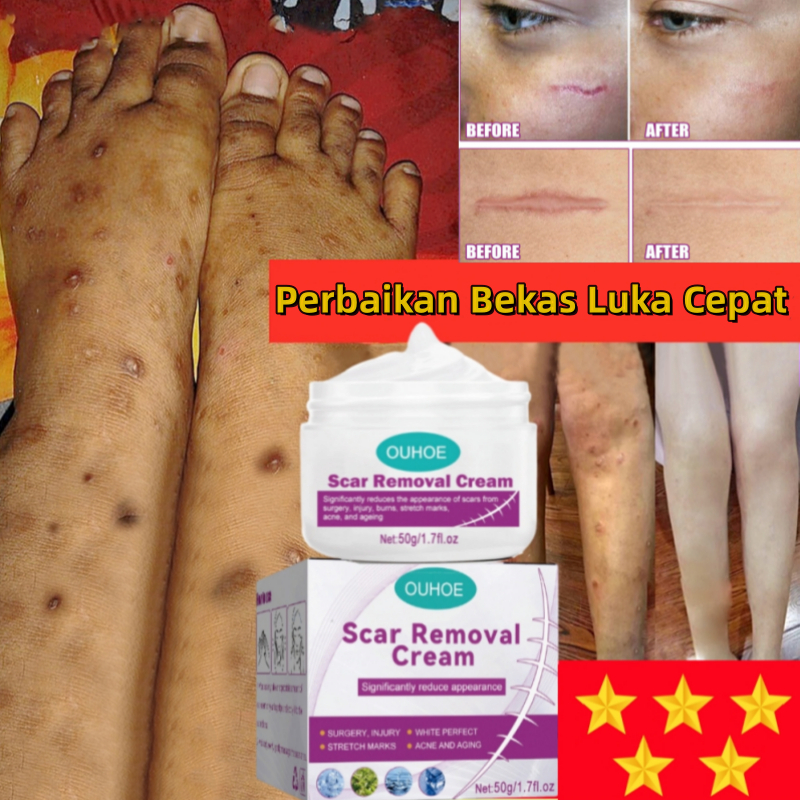 Jual Obat Penghilang Bekas Luka Salep Bekas Luka Krim Penghilang Bekas Koreng menghilangkan ...