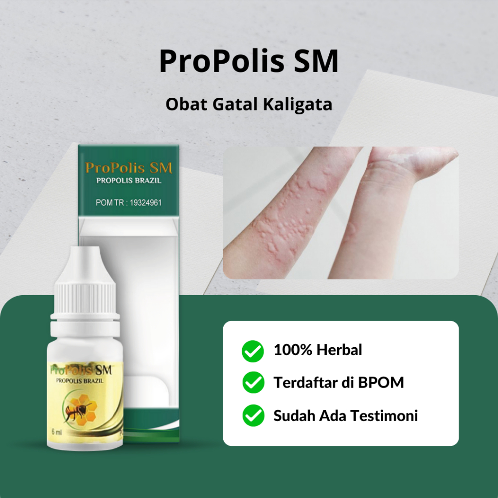Jual Propolis Sm - Obat Gatal Kaligata Kulit Bentol Bentol, Obat Gatal ...