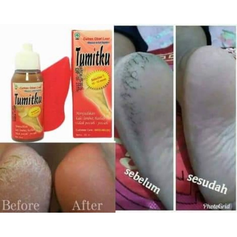 Jual (FREE KUAS+KAPAS) TUMITKU OBAT KAKI PECAH-PECAH DAN KAPALAN ...