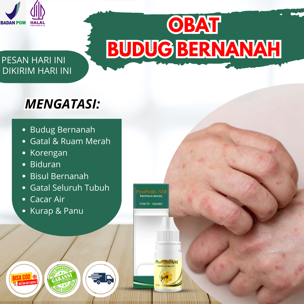 Jual Obat Budug Bernanah ,Cenang ,Gatal Ruam Perih, Kaki Korengan,Budug ...