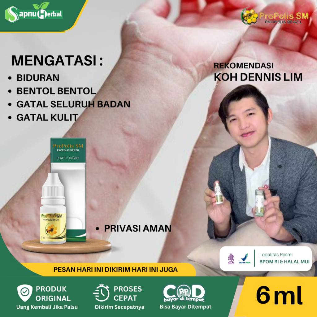 Jual Obat Biduran Gatal Gatal Alergi Dingin Makanan Kaligata Bentol ...