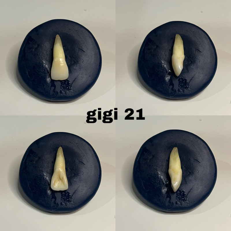 Jual Insisif 1 2 atas bawah (gigi 11 12 21 22) insisivus sentral ...