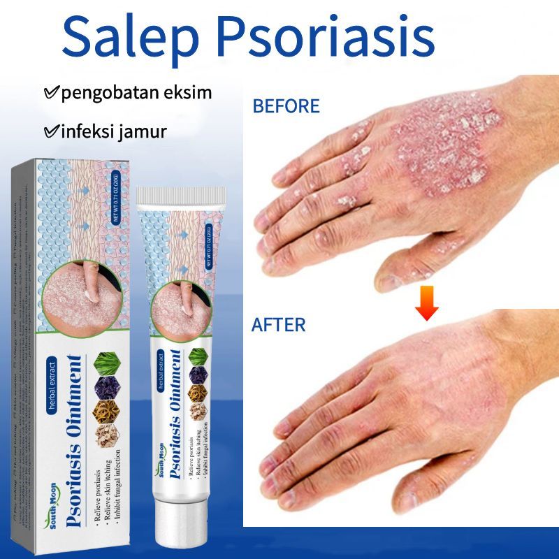 Jual Salep gatal paling ampuh Obat gatal kulit paling Ampuh Eksim ...
