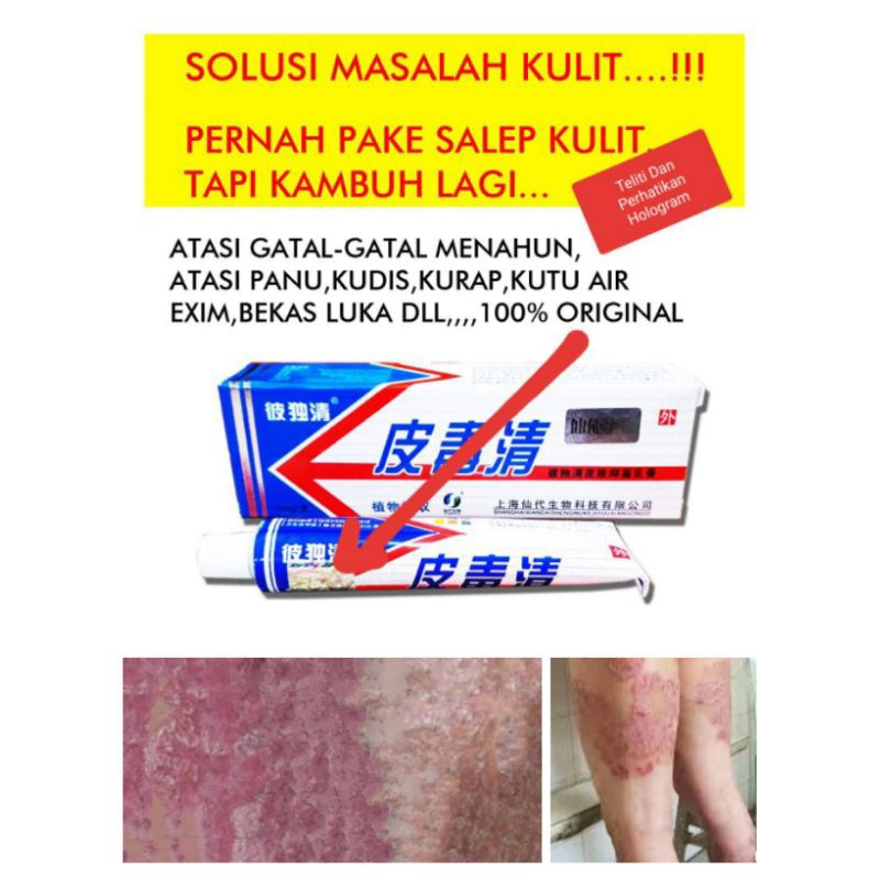 Jual Salep gatal gatal SHINSE Menahun Panu Kudis Kurap Exim Bekas Luka ...