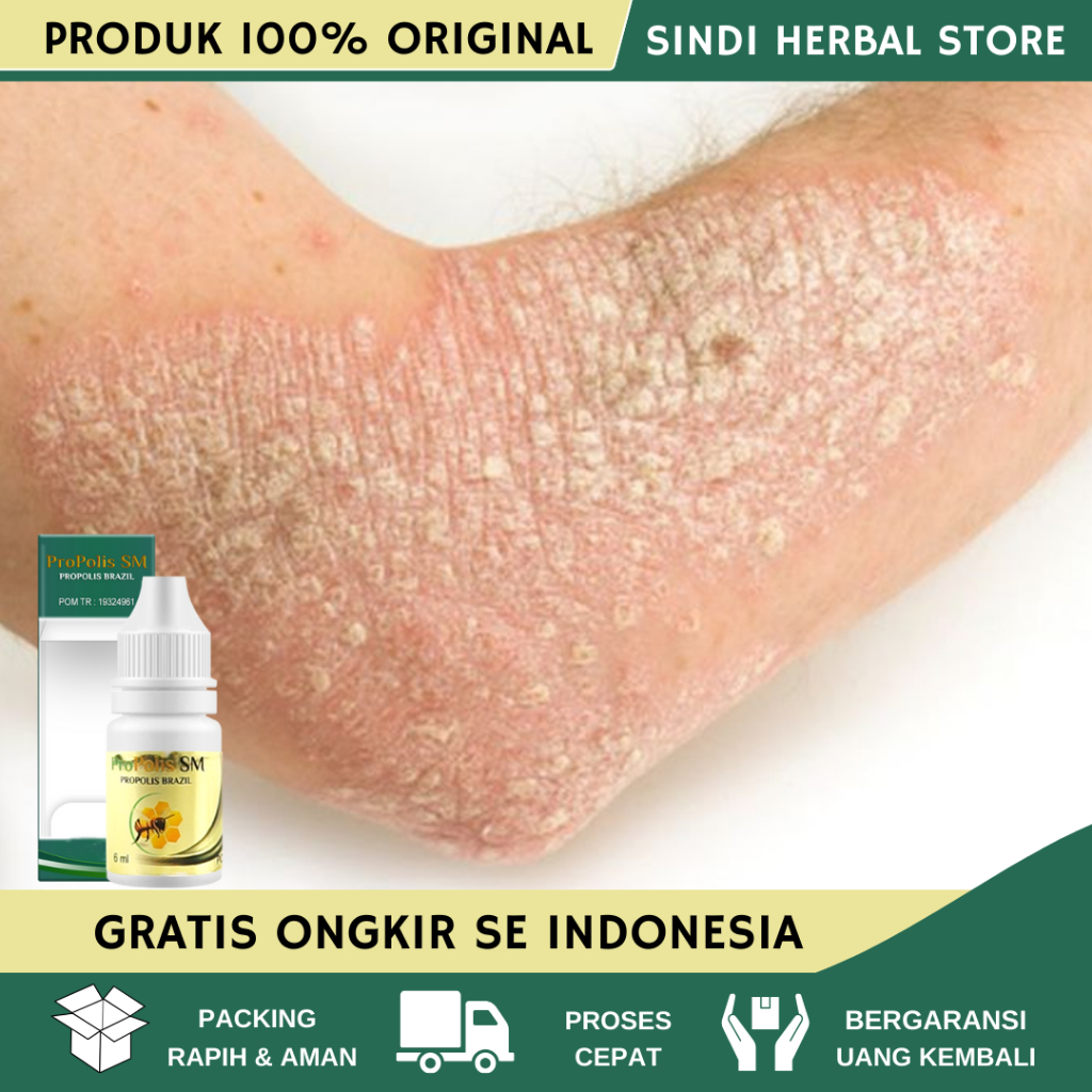 Jual Obat Eksim, Obat Gatal Eksim, Obat Gatal Exim Kering Menahun, Obat ...