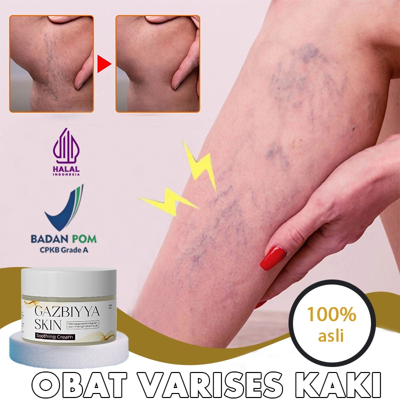 Jual Obat varises kaki valesin obat varises original salep varises obat ...