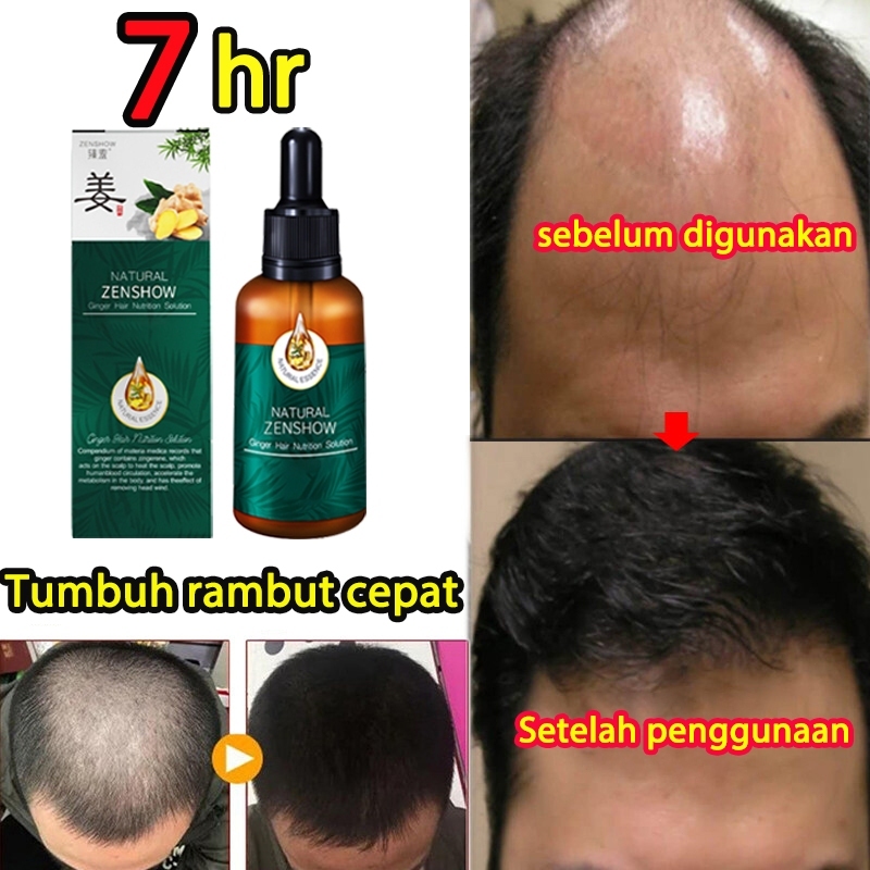Jual Cairan Essence Penumbuh Rambut Anti Rontok / Penumbuh Rambut Cepat ...