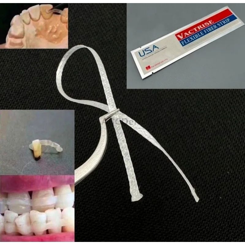 Jual Dental VACTRISE Fiber Splint Strip Retainer Splinting Ortho/Oral ...