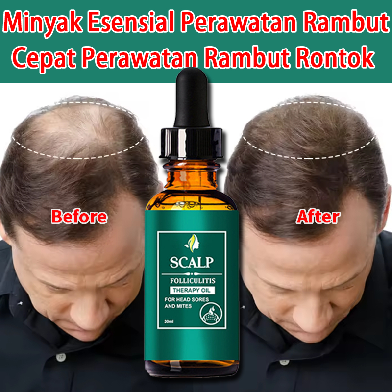 Jual Minyak Esensial Perawatan Rambut Rontok Rambut Rusak Serum ...