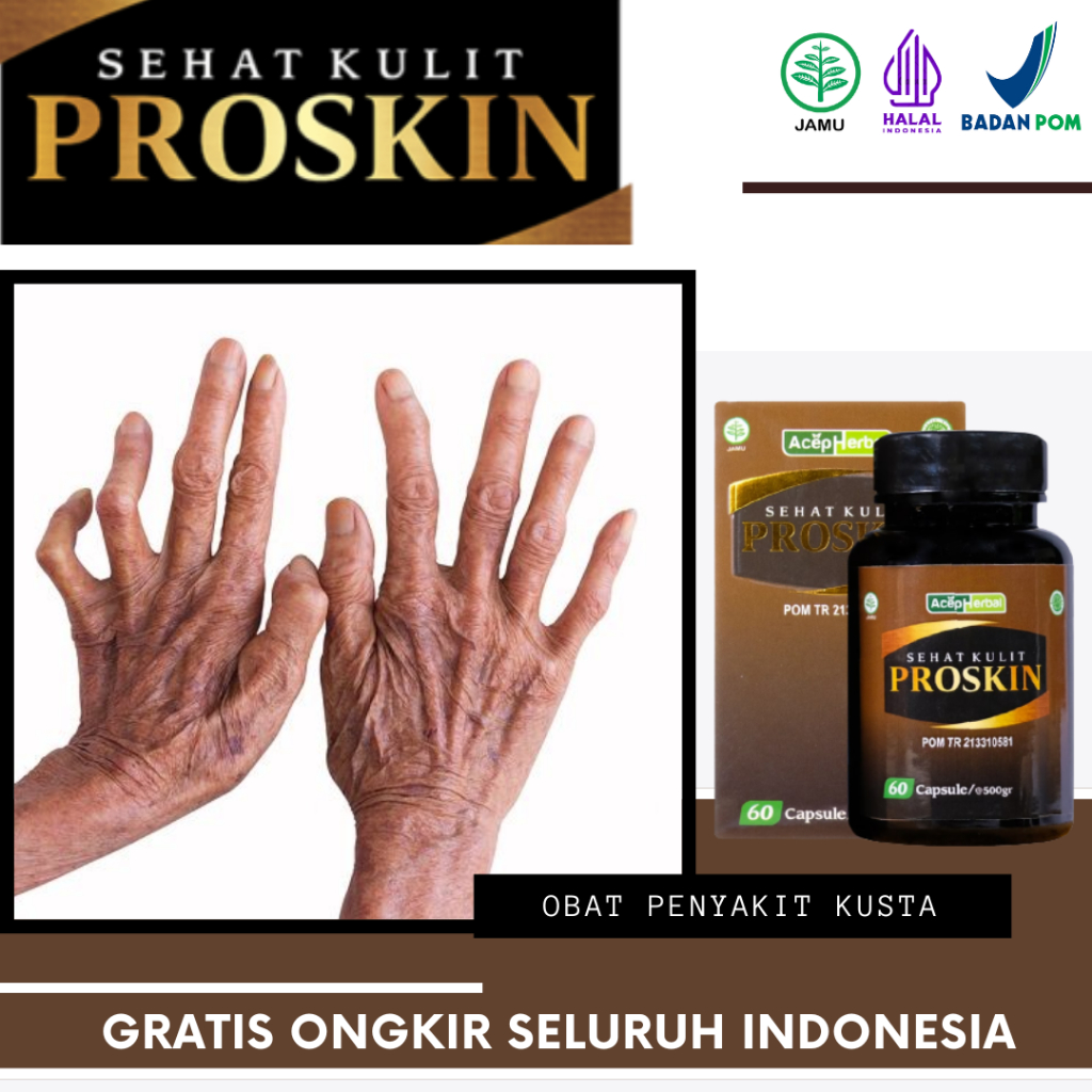 Jual Obat Kusta Kering, Kusta Basah, Lepra, Kulit Bersisik, Kulit ...