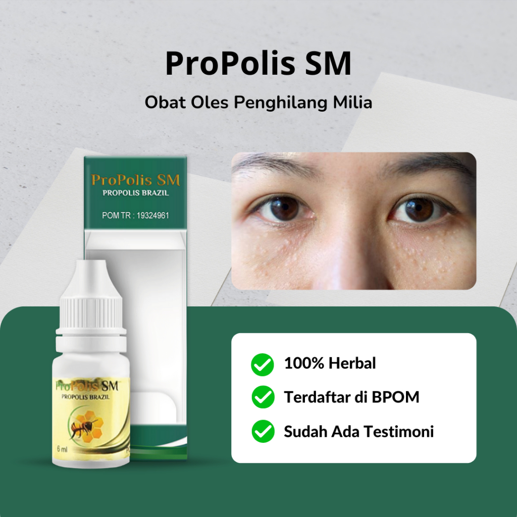 Jual Propolis SM - Obat Oles Penghilang Milia, Milia di Bawah Mata ...