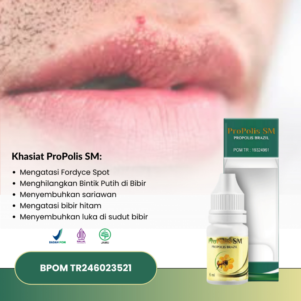 Jual Obat Penghilang Bintik Putih di Bibir Fordyce Spot, Bibir Hitam ...