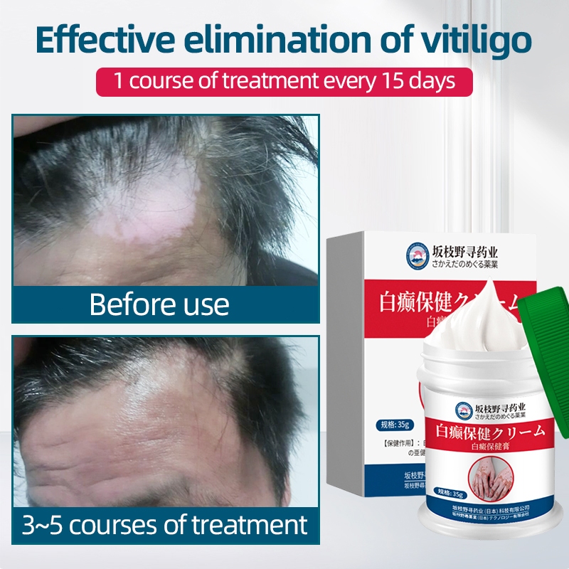 Jual [Aman dan Efektif] Obat Penghilang Vitiligo Salep Krim Vitiligo ...