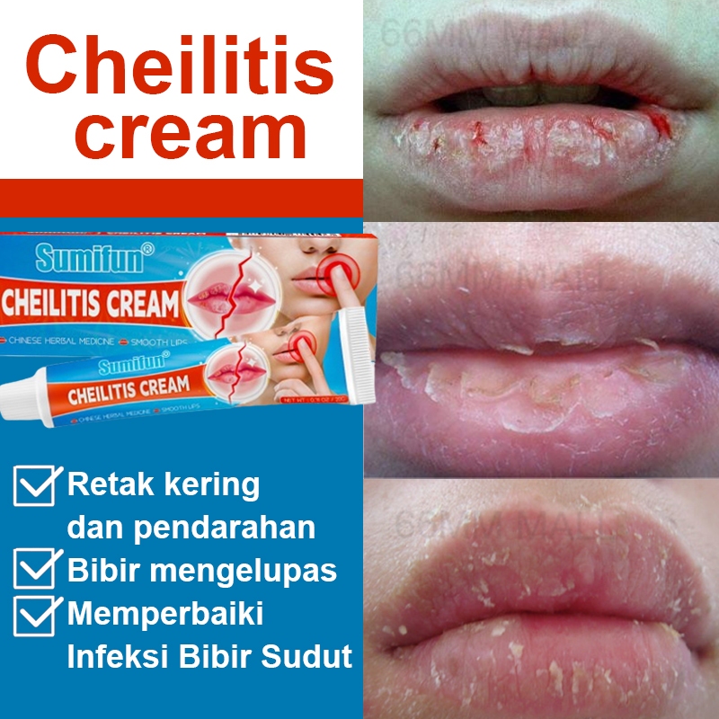 Jual Cheilitis cream pelembab bibir 20g perawatan bibir kering dan ...