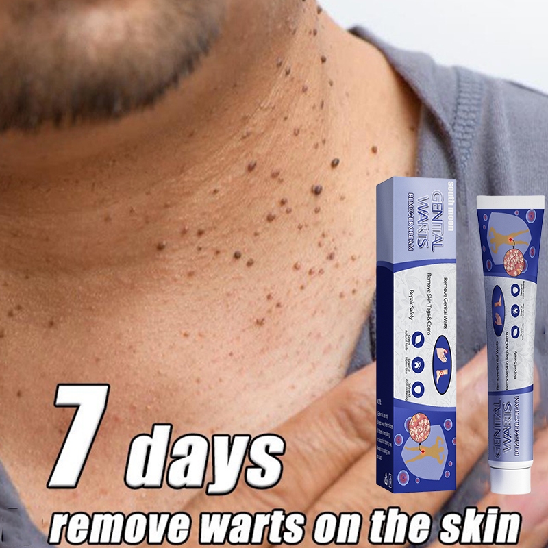 Jual skin tag remover original salep penghilang tahi lalat obat ...