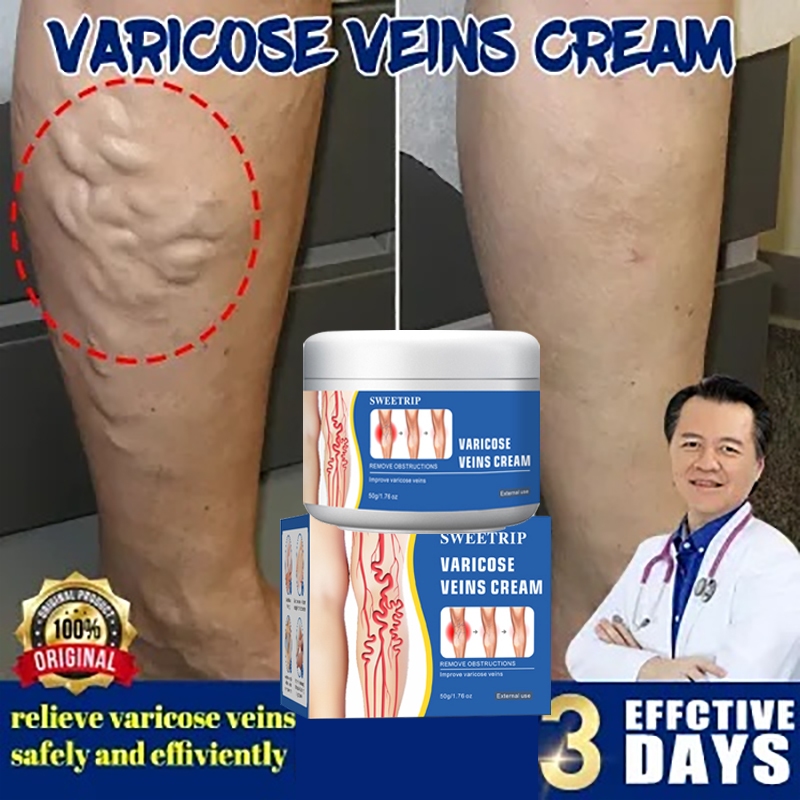 Jual Varicose Veins Cream Obat Varises Salep Penghilang Varises ...