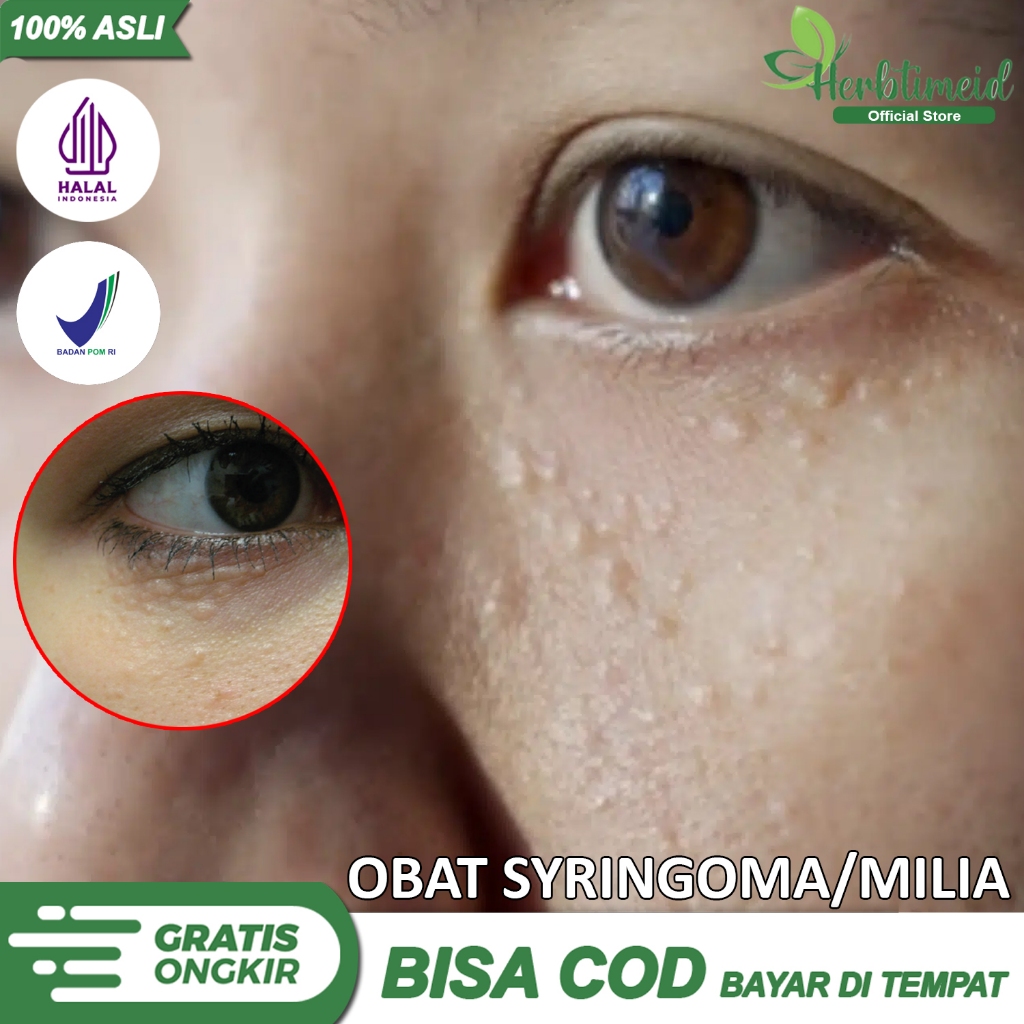 Jual Obat Syringoma Di Wajah - Benjolan Di Bawah Mata Berwarna Kuning ...