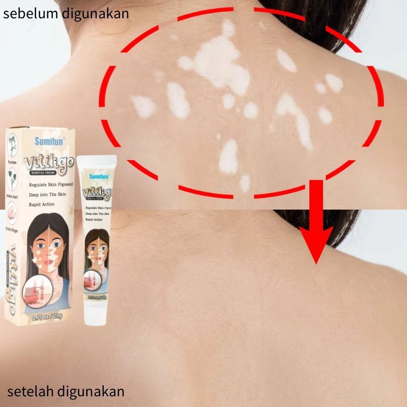 Jual Salep khusus untuk vitiligo 20g vitiligo/penyakit kulit putih/panu ...