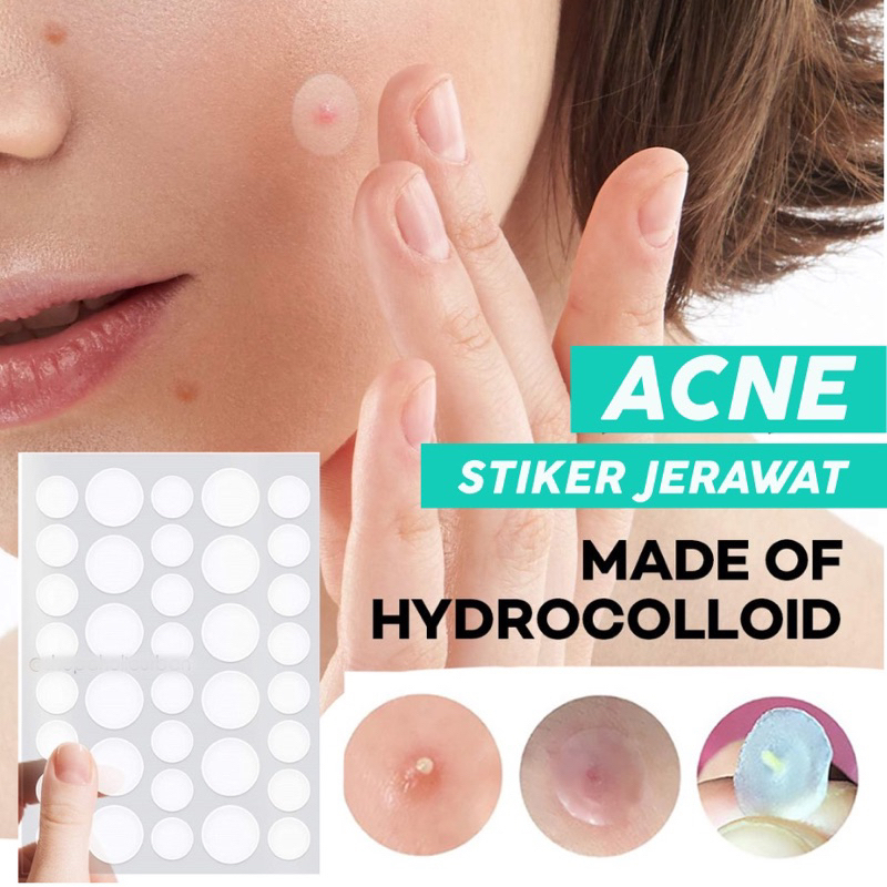 Jual Acne Patch Transparan 36pcs/Sheet /Acne Treatment Sticker | Shopee ...