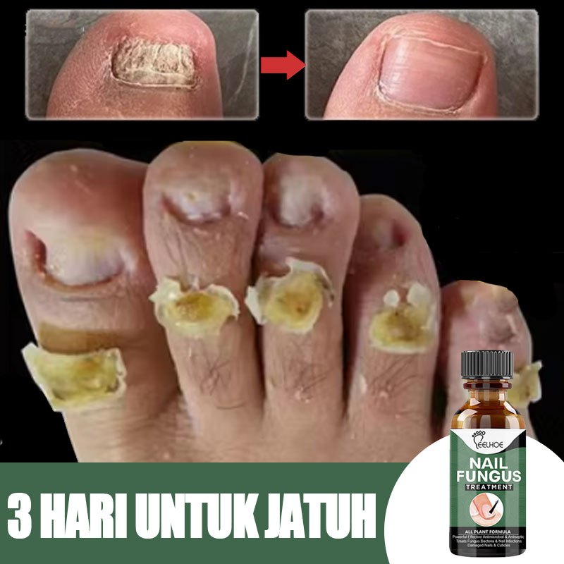 Jual Obat Jamur Kuku Serum Kuku Jamur Dan Rusak Obat Cantengan Jempol Kaki Kuku Perawatan Kuku ...