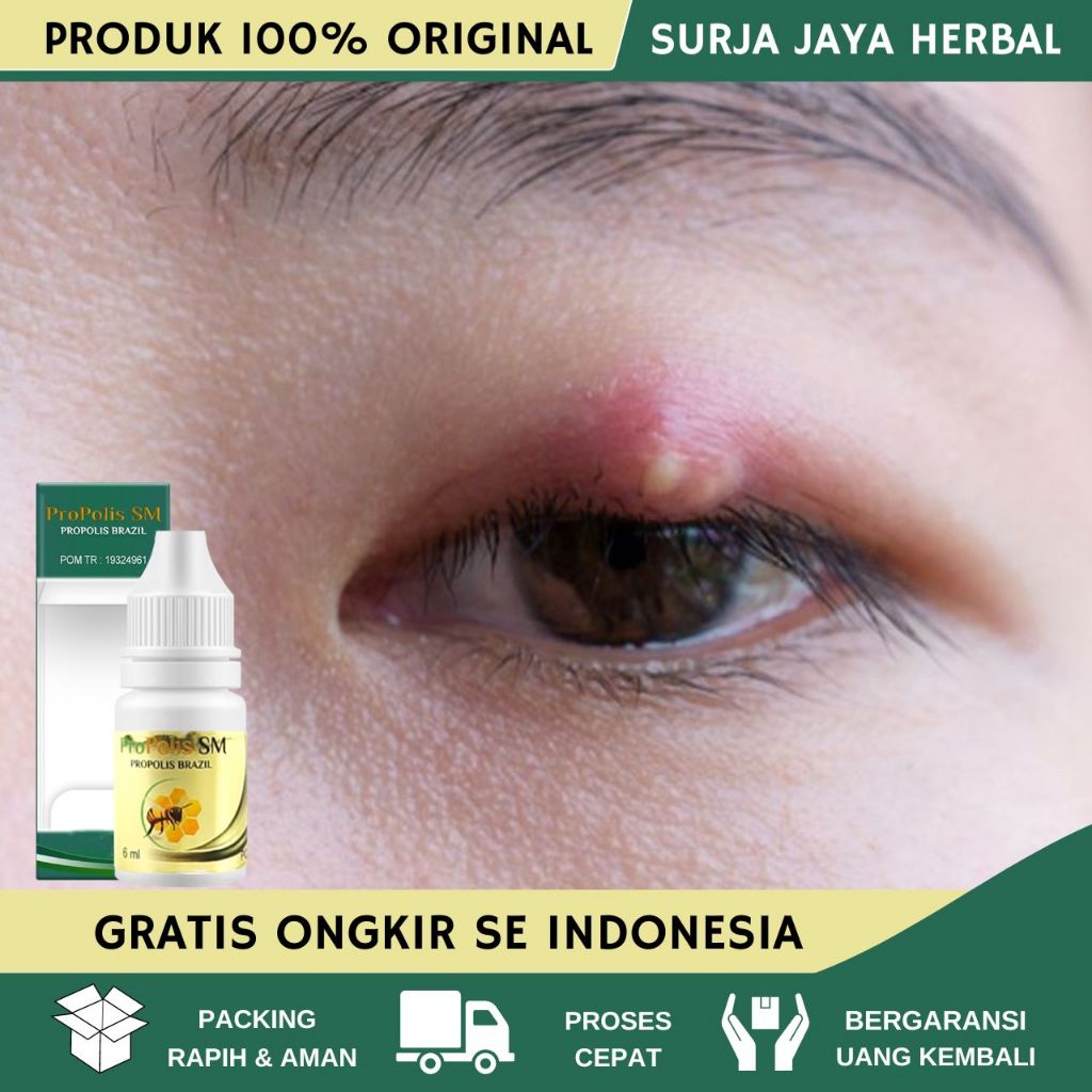 Jual Obat Mata Kalazion - Obat Penghilang Kalazion - Benjolan di ...