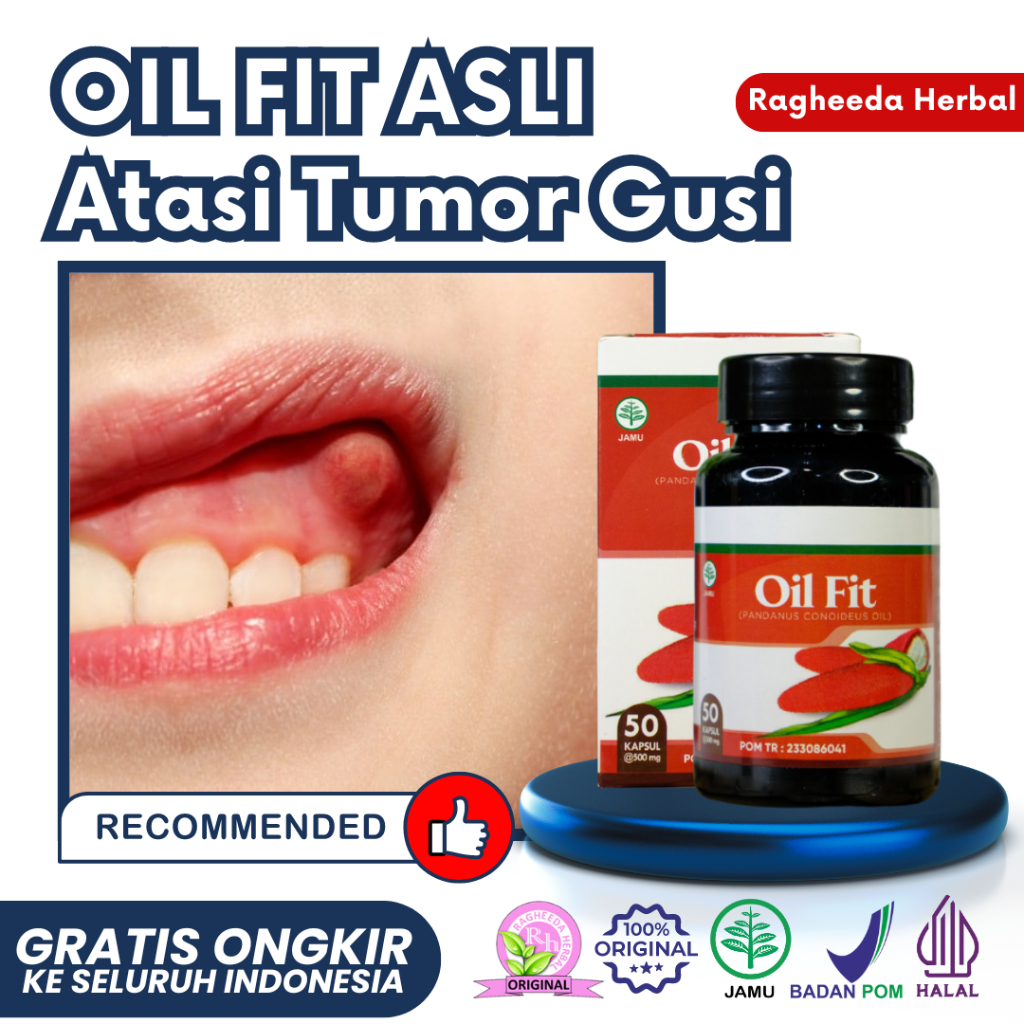 Jual Oil Fit Kapsul 100% Original - Obat Tumor Fibromatosis Gusi ...