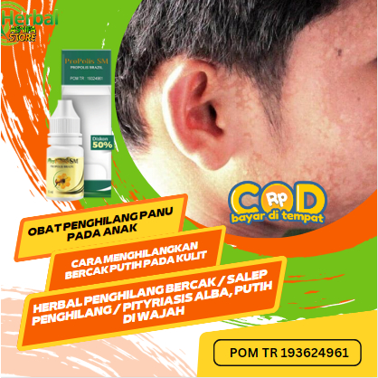 Jual Obat Penghilang Panu Pada anak | Cara Menghilangkan Bercak Putih ...