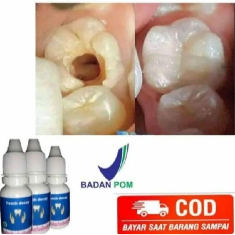 Jual Viral 2x OLES LANGSUNG TUMBUH PERMANEN, PENUMBUH GIGI BOLONG DAN ...
