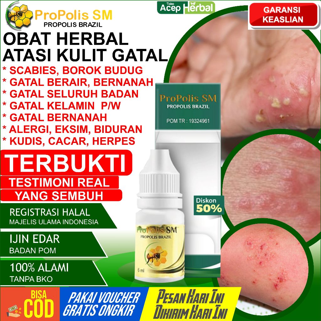 Jual Obat Scabies Kulit Borok Bernanah Cenang Budug Untuk Seluruh Badan ...