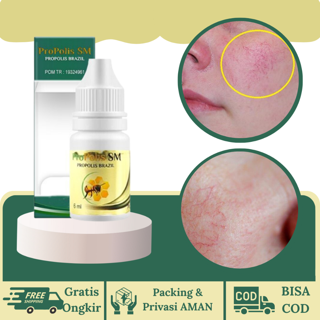 Jual Herbalthy - Obat Penghilang Urat Halus Di Wajah (spider veins ...
