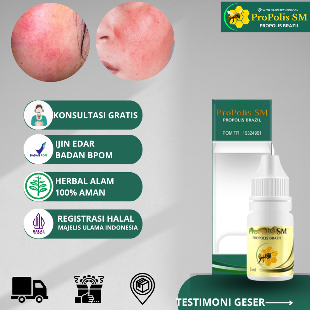 Jual Obat Oles Penghilang Spider Veins Original BPOM, Obat Tetes Spider ...